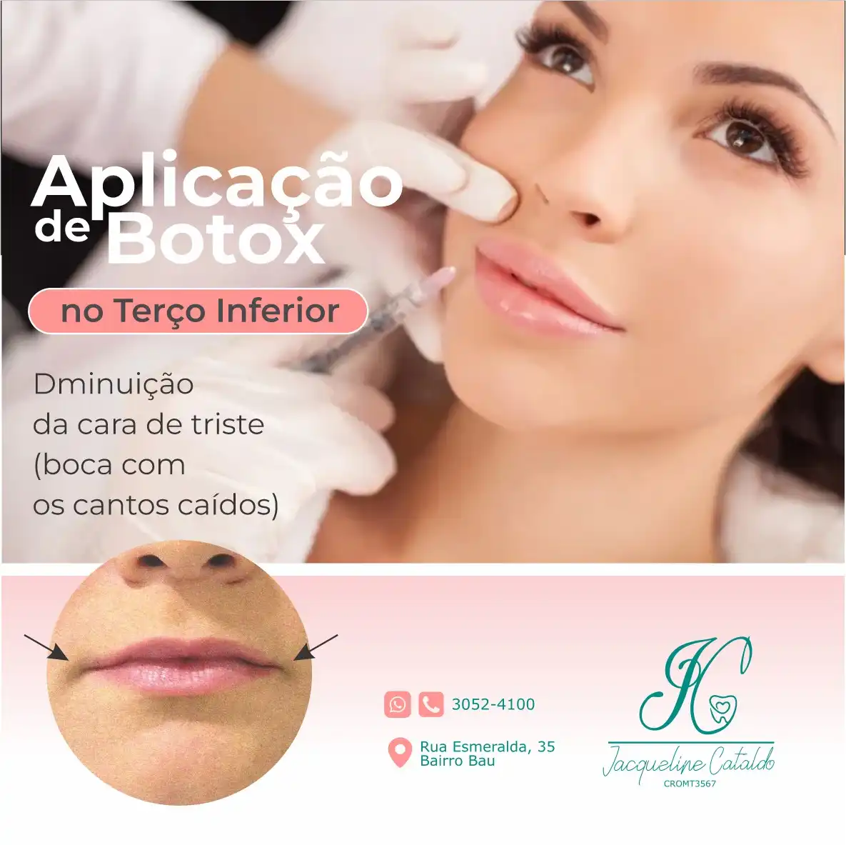 Propaganda Aplicação de Botox Terço Inferior do Rosto Estética Facial ...